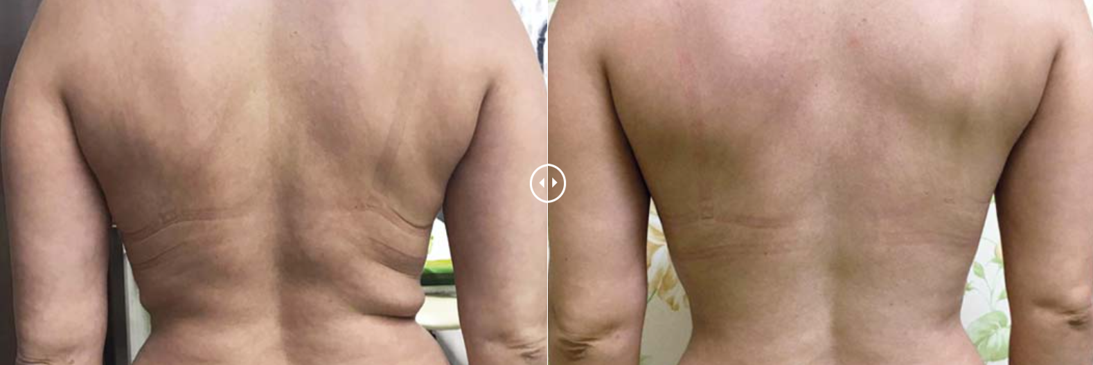 ONDA PLUS一叮溶脂療程 | $1180即可瓦解頑固脂肪團